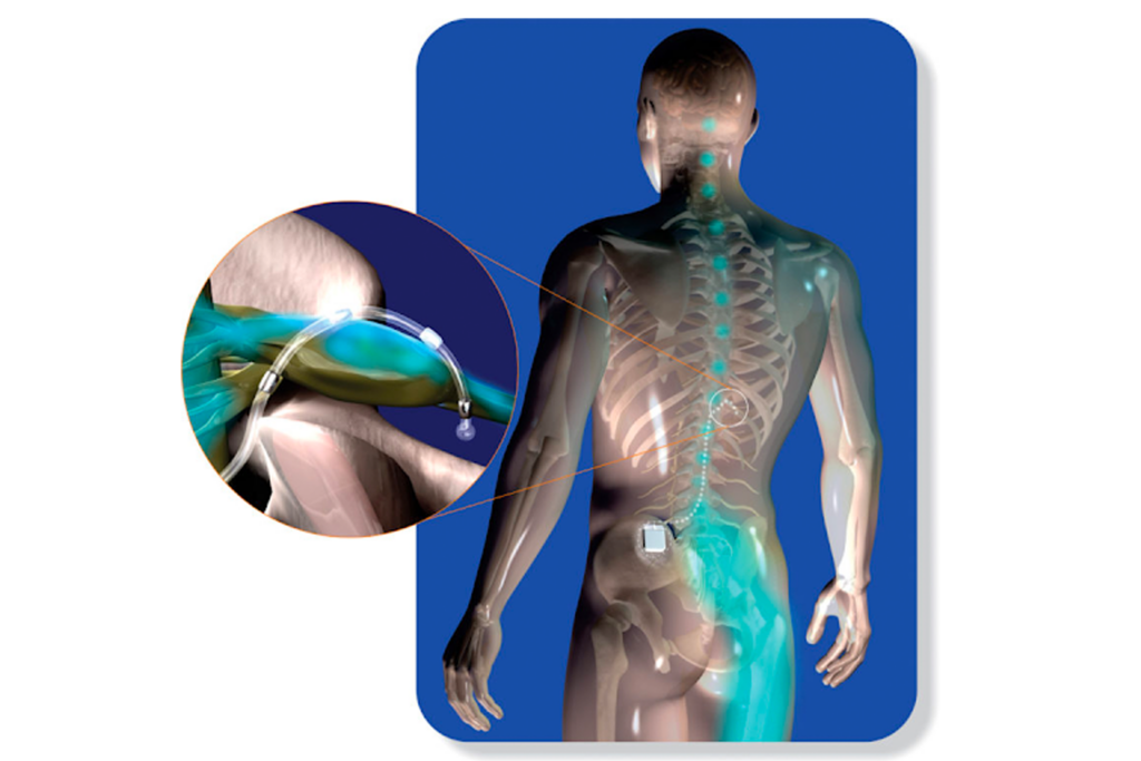 Dorsal Root Ganglion (DRG) Stimulation Therapy - Coastal Health